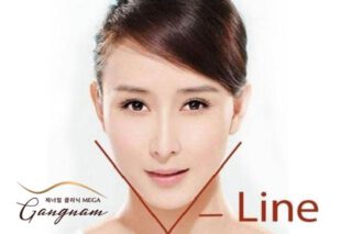 Tạo dáng cằm V-line công nghệ nào tốt nhất?