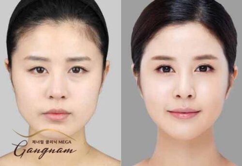 Tạo dáng cằm V-line công nghệ nào tốt nhất?