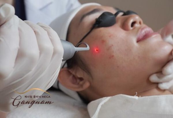[ Review ] Bắn laser điều trị nám có thật sự hiệu quả không?