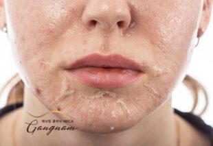 Có nên peel da mặt thường xuyên hay không?