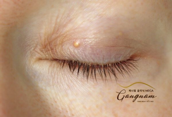 Điều trị mụn cơm ở mặt bằng cách nào an toàn và hiệu quả nhất?