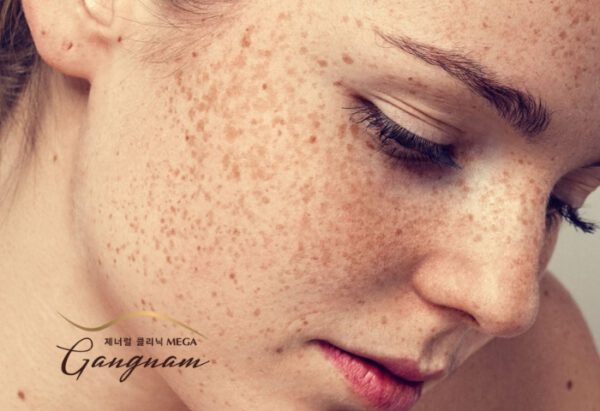 What is skin pigmentation disorder? Can it be completely treated?