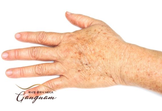Symptoms and treatment of hand skin pigmentation disorders