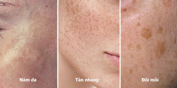 Da bị đốm nâu trên mặt có phải là nám không? Cách loại bỏ an toàn