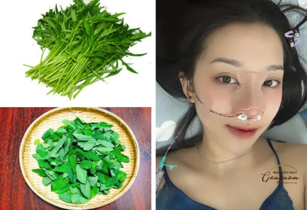 [Giải đáp] Làm mũi kiêng rau gì để mau lành, giảm sưng
