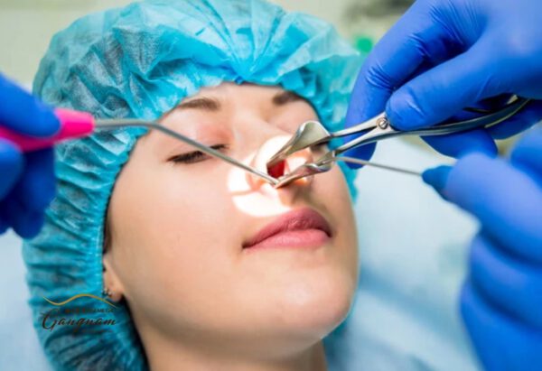 Nâng mũi sụn Surgiform là gì? Ưu nhược điểm và thời gian duy trì