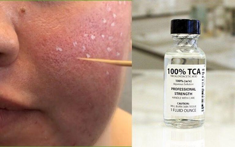 Giải đáp: TCA chấm tàn nhang là gì? Có an toàn không?