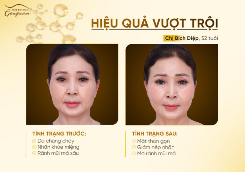 5 lợi ích tuyệt vời khi căng da mặt bằng chỉ collagen