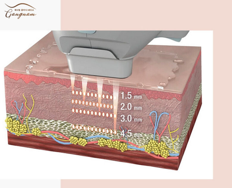 Công nghệ Hifu Ultrasound là gì? Có hiệu quả không?