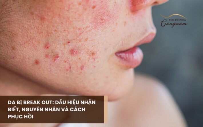 Da bị break out: Dấu hiệu nhận biết, nguyên nhân và cách phục hồi