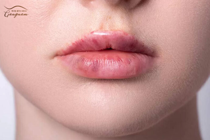 Tiêm môi hỏng: Dấu hiệu nhận biết và khắc phục kịp thời